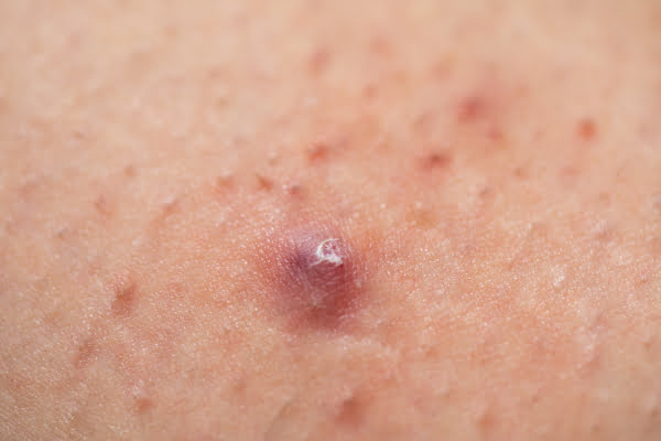 Folliculitis – Dermatology Group of the Carolinas