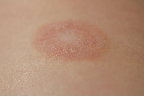 Pityriasis Rosea